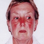 Malar Rash (Butterfly Rash) - Pictures, Causes, Diagnosis and Treatment